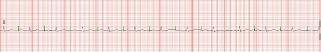 EKG Rhythm Strip Quiz 56: Paced Rhythms