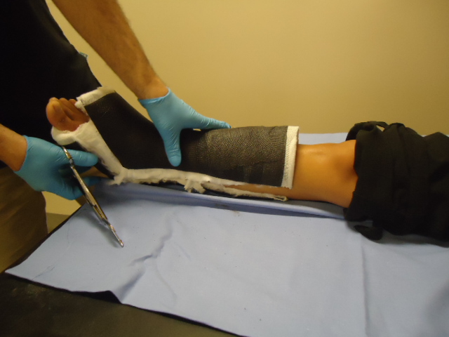 The Zipperfoot Journals: Severed EHL Tendon: 6 Week Post-Op