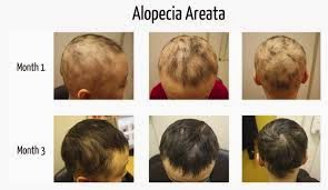 Acrochordon (Skin Tags) treatment: Alopecia Areata Treatment by Dr ...