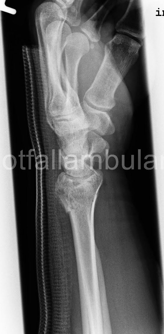 Brennpunkt Notaufnahme: Fall 25 Die distale Radiusfraktur (Therapie)