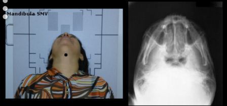 Ossos da Face- Mandibula SMV