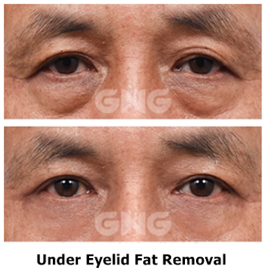 GNG Plastic Surgery Hospital: Eyelid Fat Surgeries make your face ...