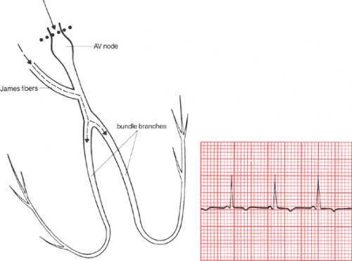 Lown–Ganong–Levine症候群 Lown–Ganong–Levine syndrome