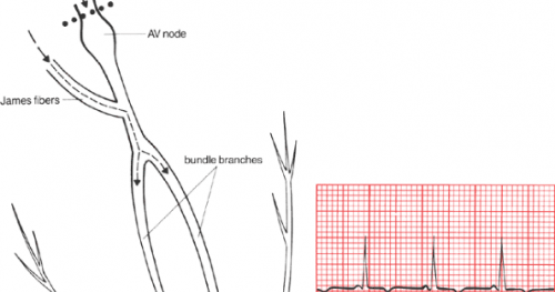 Lown–Ganong–Levine症候群 Lown–Ganong–Levine syndrome
