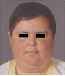 Dentistry lectures for MFDS/MJDF/NBDE/ORE: Oral manifestations of ...