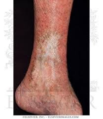 Medical Treatment Pictures-for Better Understanding: Hemosiderosis