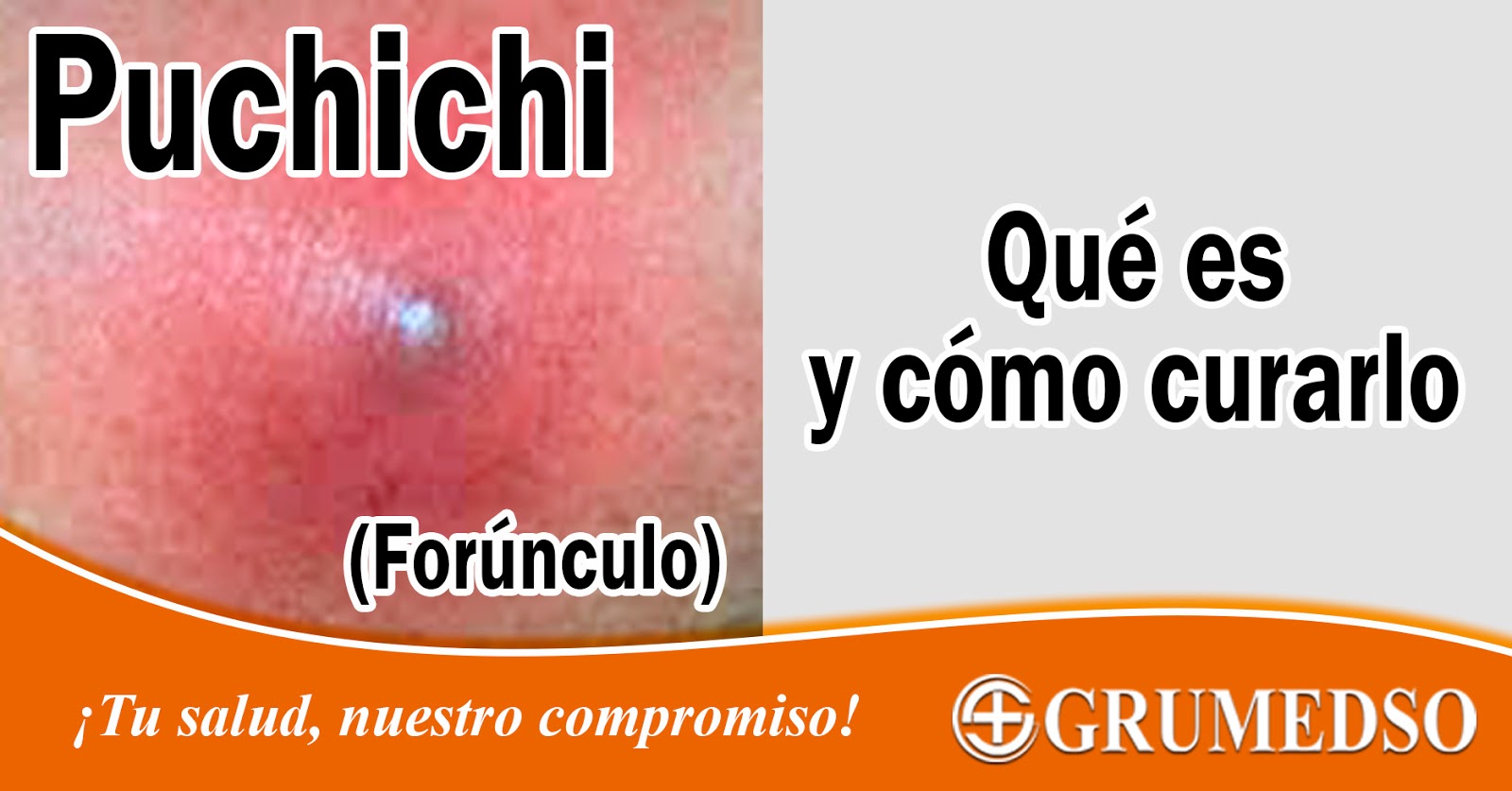 CLINICA GRUMEDSO: PUCHICHI - QUÉ ES Y COMO CURARLO
