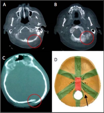 Fractura Craneal Basilar; Fractura Basilar del Cráneo; Signo de Battle ...