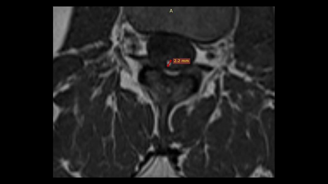 Ultimate Radiology : Fatty filum terminale