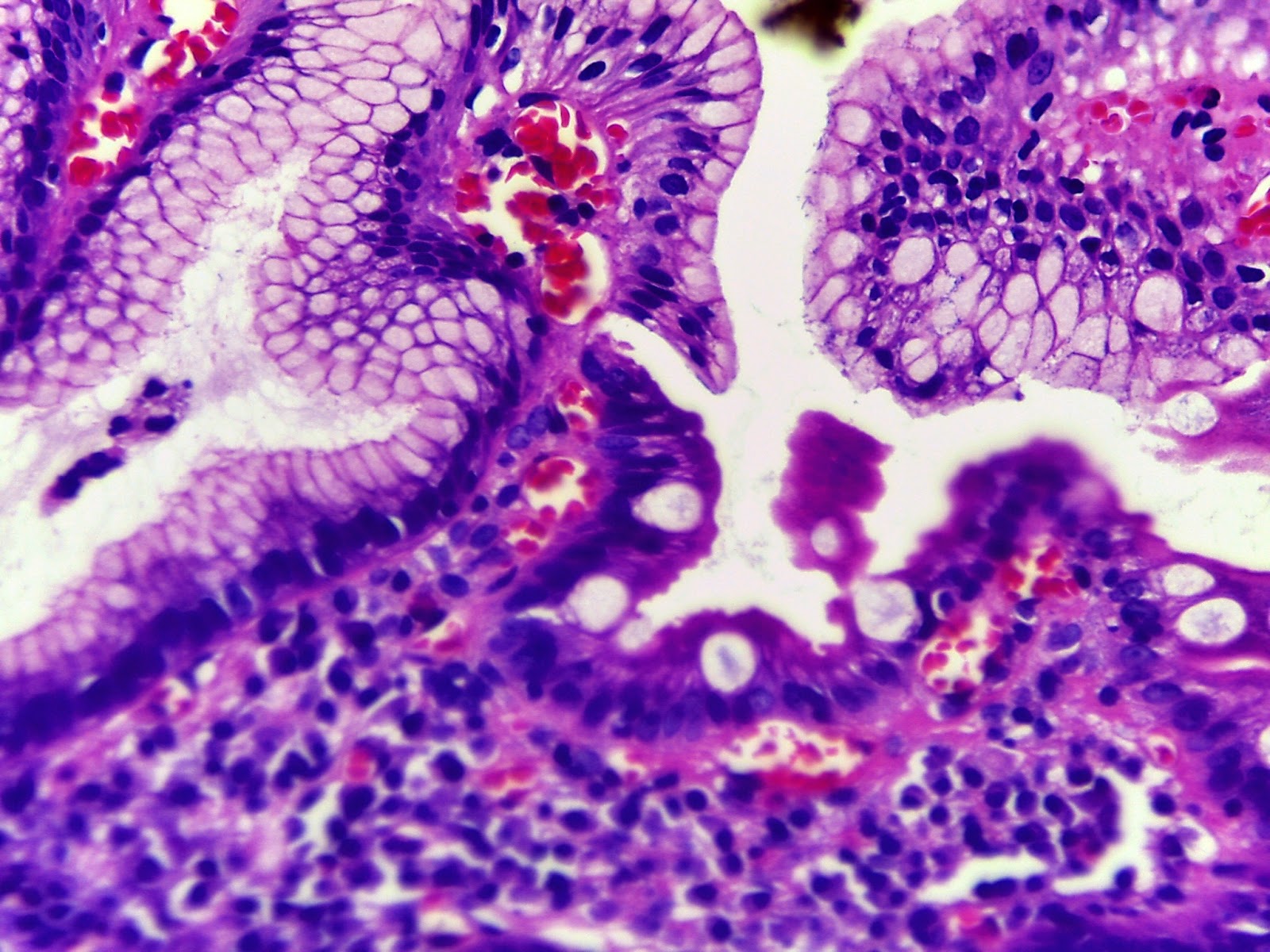 GASTROINTESTINAL AND LIVER HISTOLOGY PATHOLOGY ATLAS: DUODENUM: PEPTIC ...