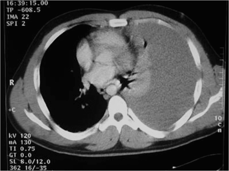 PATOLOGIAS DE TORAX EN TAC: PATOLOGIAS DE TORAX EN TAC