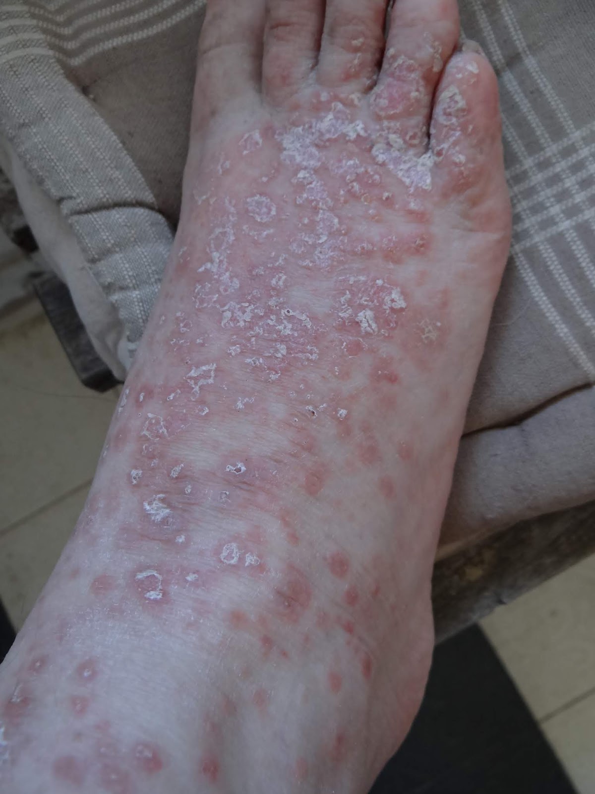 Scarlet Letters, dealing with vascular rosacea, face flushing, burning ...