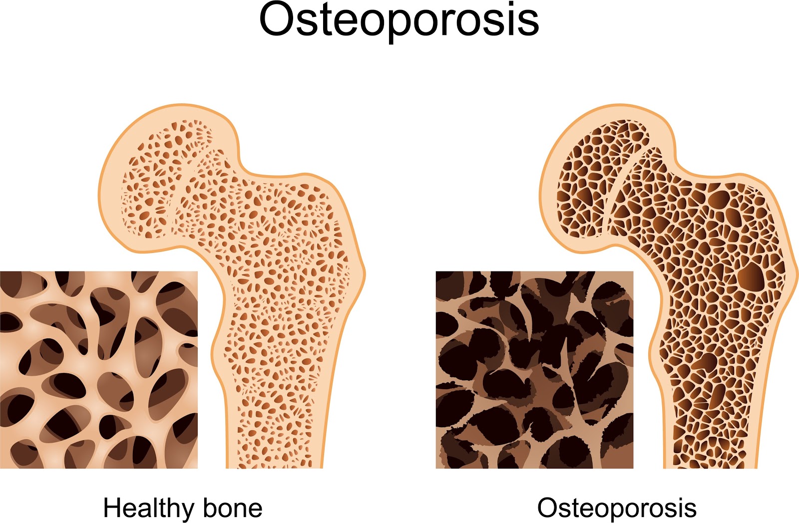 DEDICATED TO ALL WOMEN OF THE WORLD: OSTEOPOROSIS(thinning of bones)