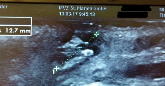 Pilonidal cyst on the butt: How is a pilonidal cyst diagnosed?