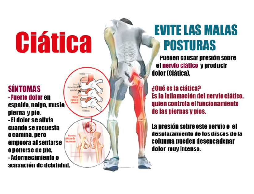 Que Es La Ciatica Y Que La Produce at Jennifer Johansen blog
