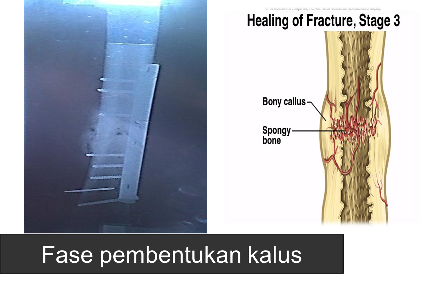 Creatio ex Nihillo: GAMBARAN RONTGEN PROSES PENYEMBUHAN FRAKTUR TULANG