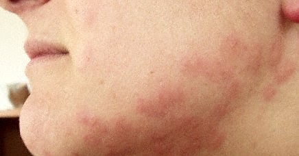 Bettwanzenbisse / Bettwanzenstiche, erkennen und behandln ~ Bettwanzen ...