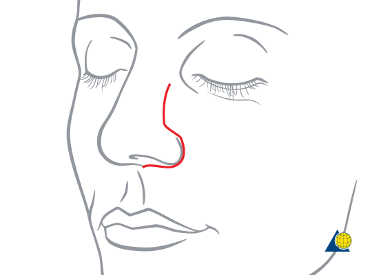 ENT for medical students: ENT PICTURES - NOSE