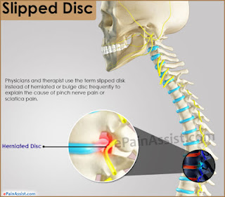 Disc Slip Treatment