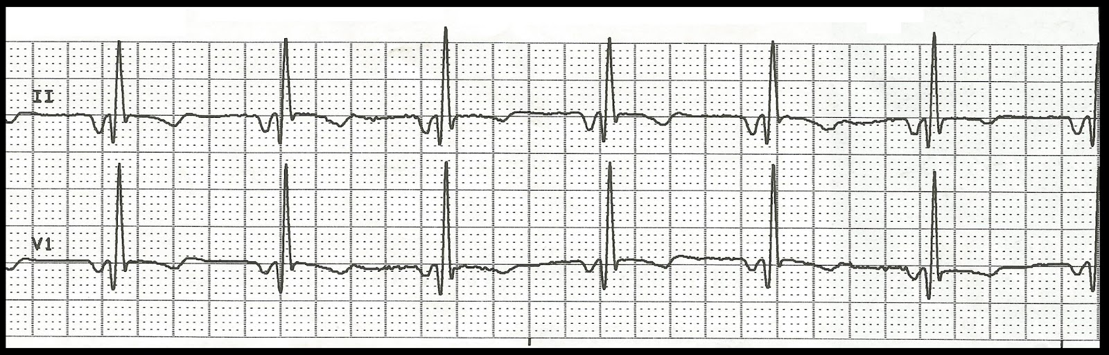 EKG Rhythm Strip Quiz 113