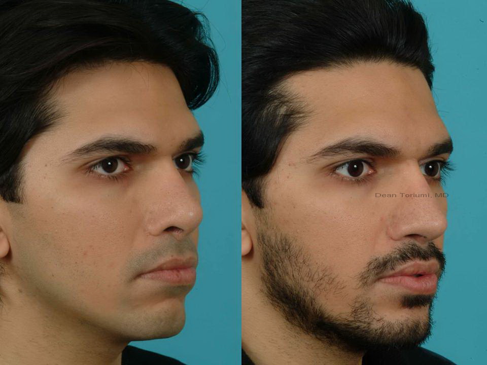 Dr. Dean Toriumi Reviews: Dean Toriumi Reviews: Nasal length restored ...