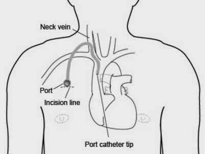 My Decision to Get a Port