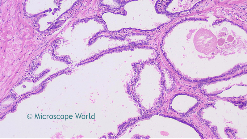 Microscope World Blog: Prostate Cancer under the Microscope