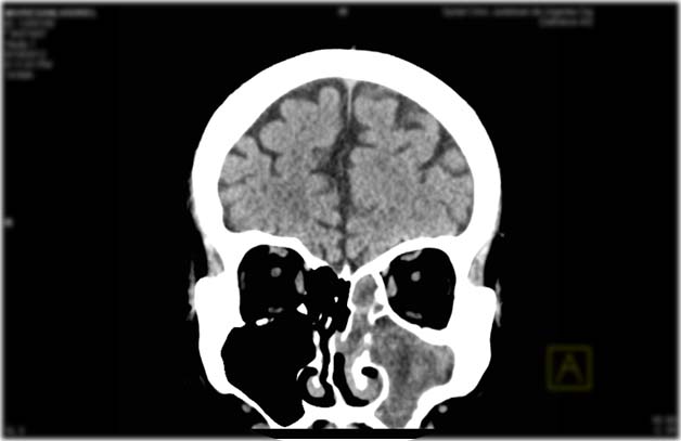 Pansinusitis on the left side - CT Scan