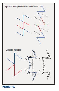 MedicoDelFuturo: Plastias en Z o zetaplastias