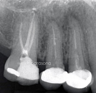 CONDUCTOS CALCIFICADOS