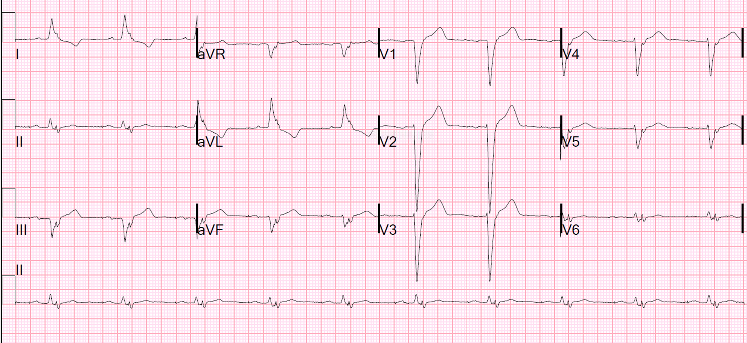 Dr. Smith's ECG Blog: CHF Exacerbation with Old LBBB: Is There New ...