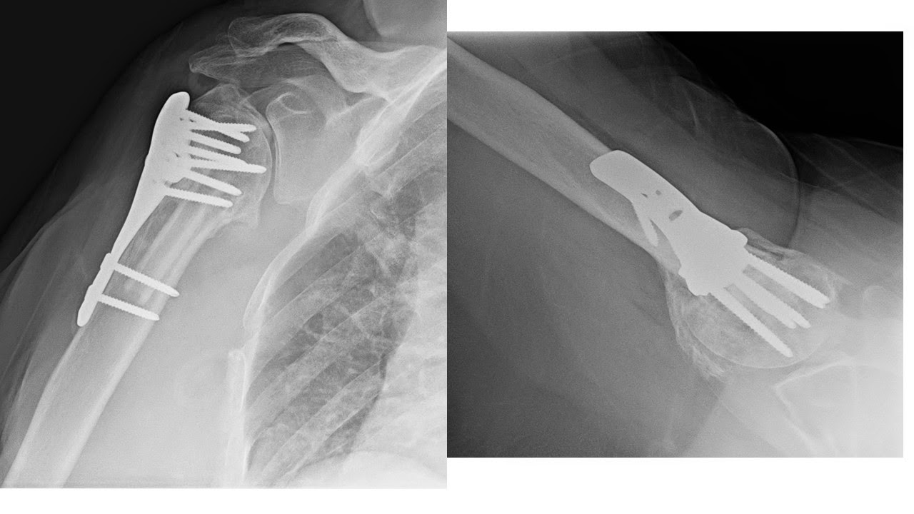 Shoulder and Elbow Surgery: Humeral head split in the elderly - Is ...