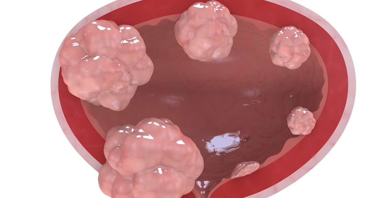 Cancer vessie symptomes - Cancer de la vessie traitement. - Articles à ...