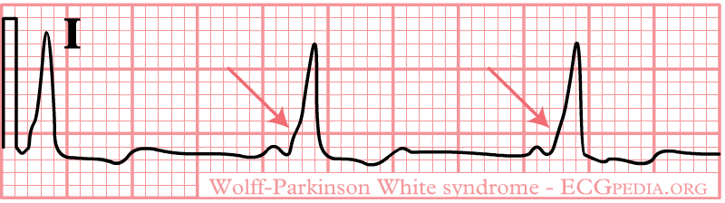 Wolff–Parkinson–White症候群 Wolff–Parkinson–White syndrome, WPW sydnrome