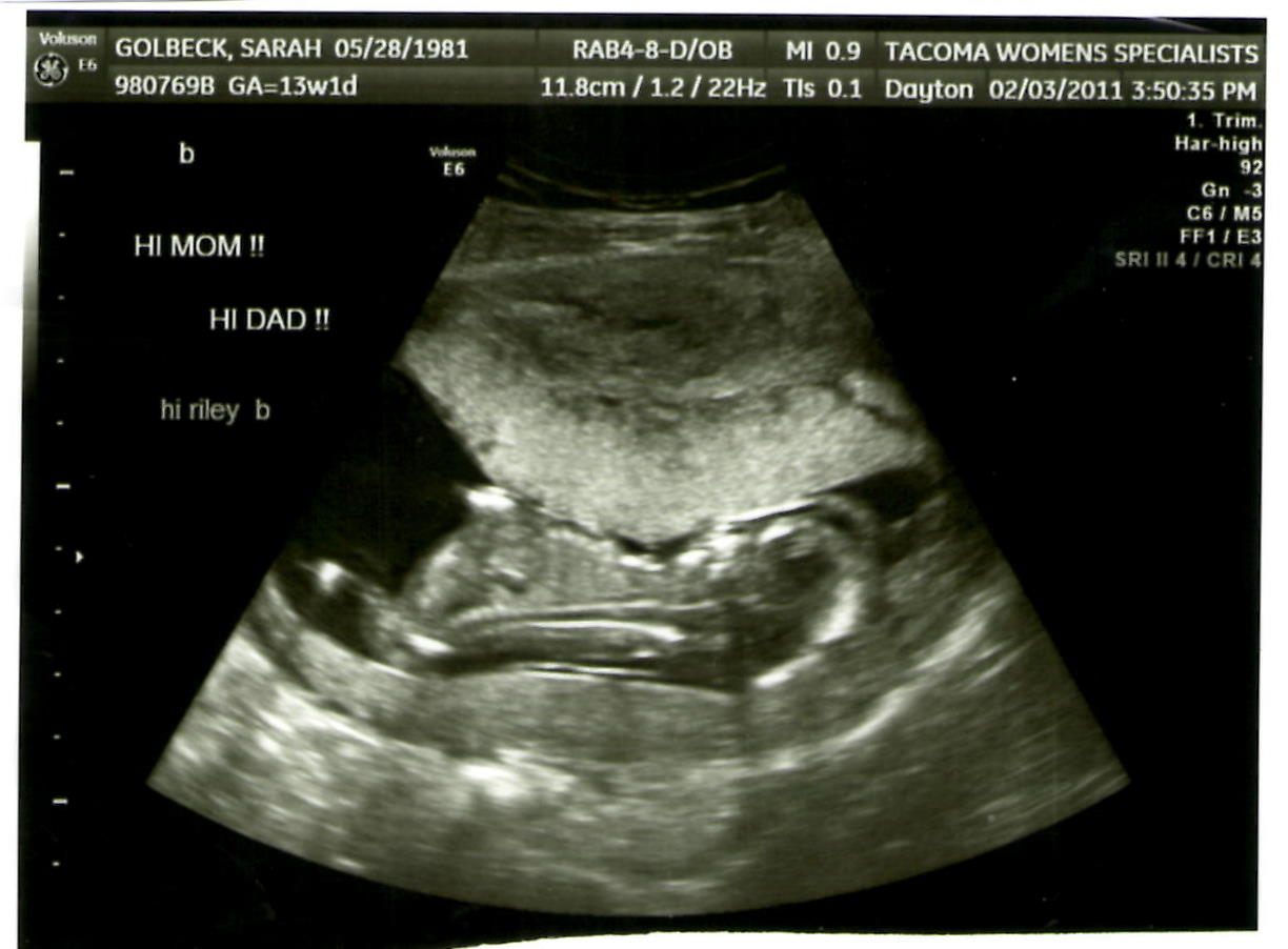 The Golbecks: Ultrasound 13 weeks