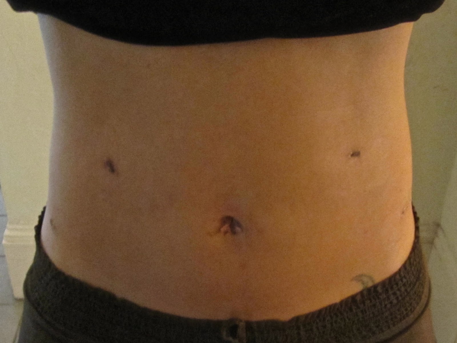 Fibroid Surgery: Recovery Ruminations: Day 14 (Friday) - Part 2: Post-Op