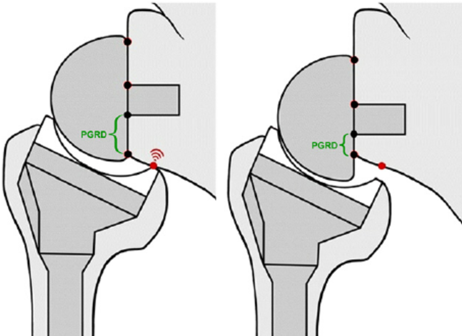 Shoulder and Elbow Surgery: The ideal position of the glenosphere in ...