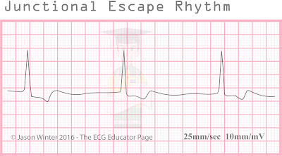 ECG Educator Blog : Junctional Rhythms
