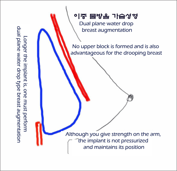 Dr. Lee Breast augmentation Korea: Dual plane teardrop - breast augmentation Korea KIES-U