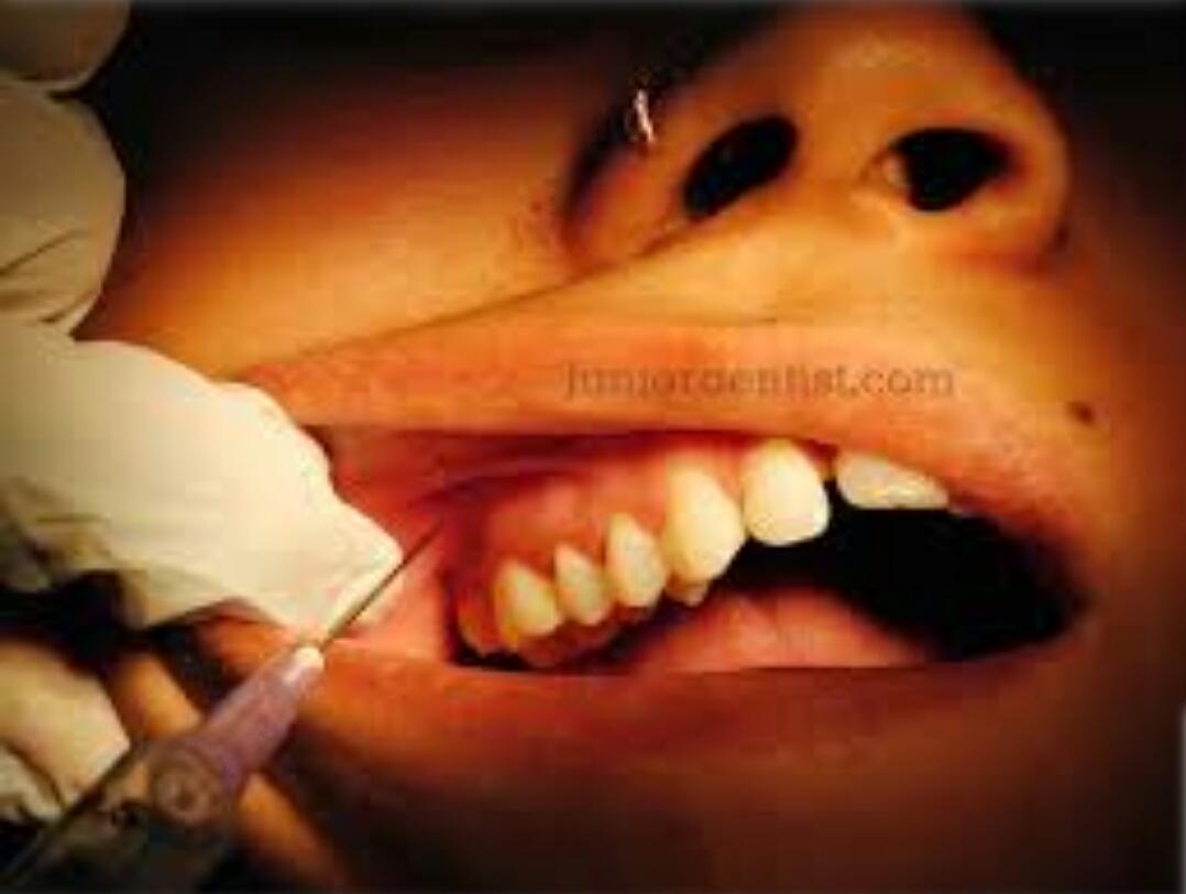 Superior Alveolar Nerve Block