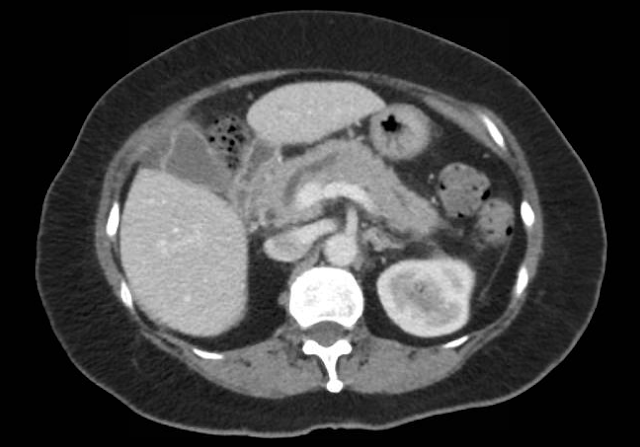 Emergency Medicine Visual Diagnosis: Painful Constipation