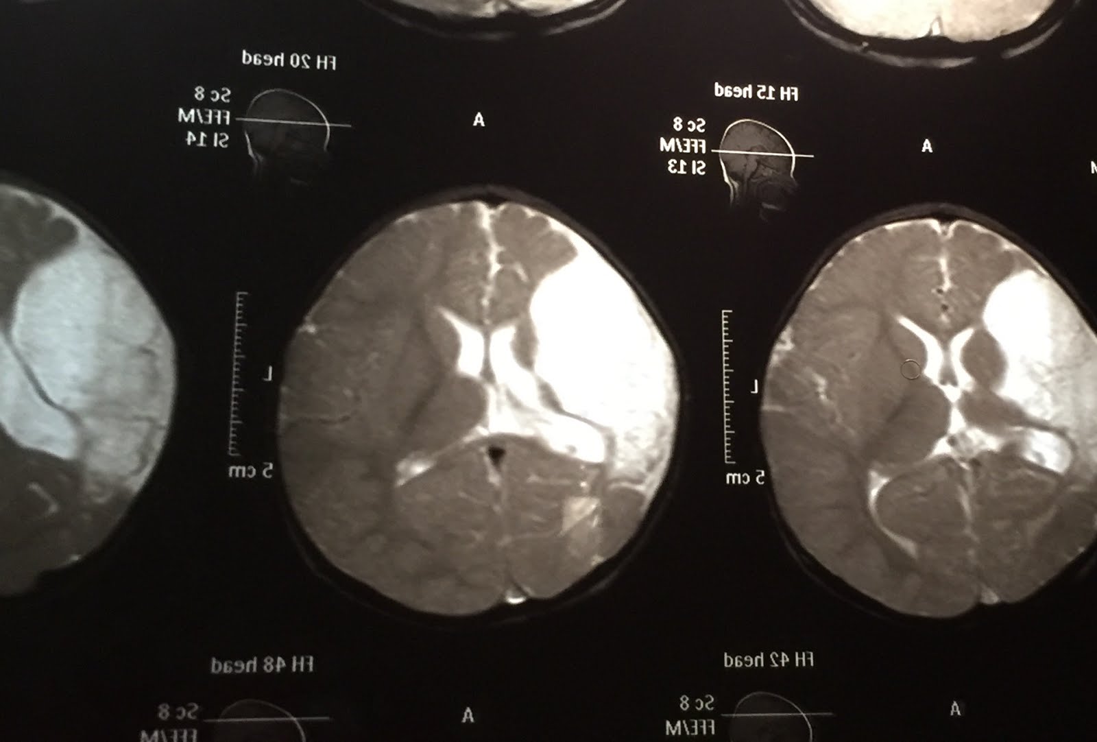 Byron's Wonderful World: Surgery - The Functional Hemispherectomy