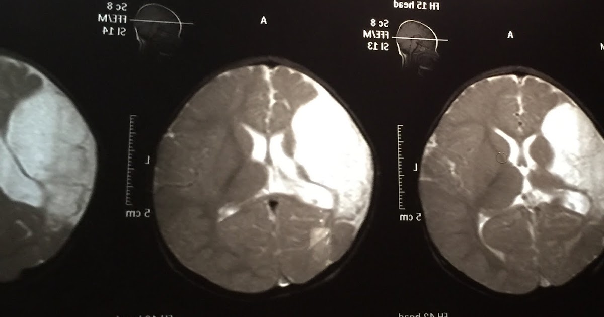 Byron's Wonderful World: Surgery - The Functional Hemispherectomy