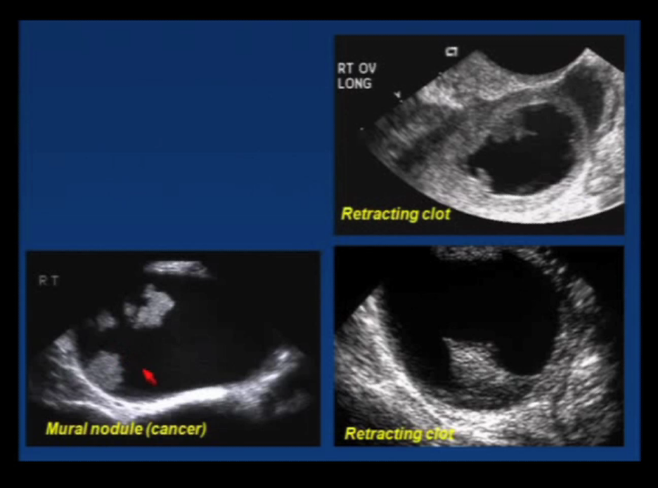 rsna: hemorrhagic ovarian cyst