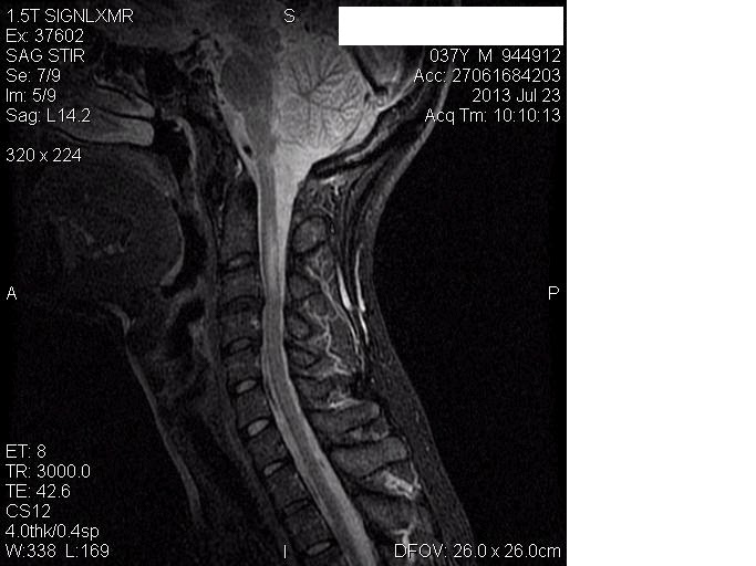 Se me rompió la columna: Imagen y Clínica. Falsa Esclerosis Múltiple.