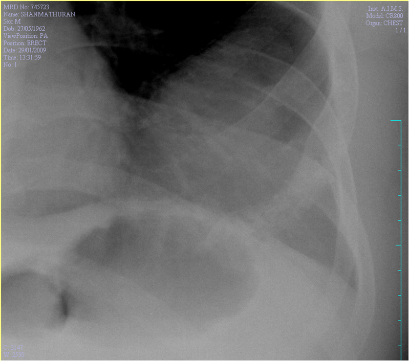 RADIOLOGY IMAGE SPOTTERS: Chondrosarcoma rib
