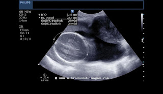 cochinblogs: Pregnancy with fibroid and hypocoiled cord: