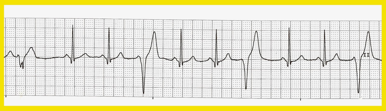 EKG Rhythm Quiz 239