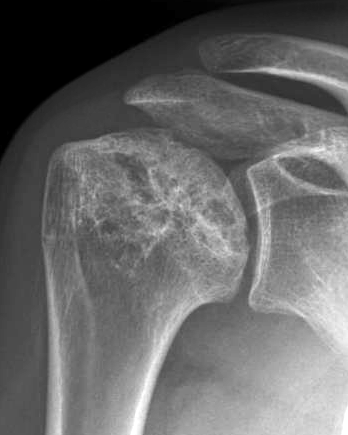 UW Shoulder and Elbow Academy: Hemiarthroplasty for avascular necrosis