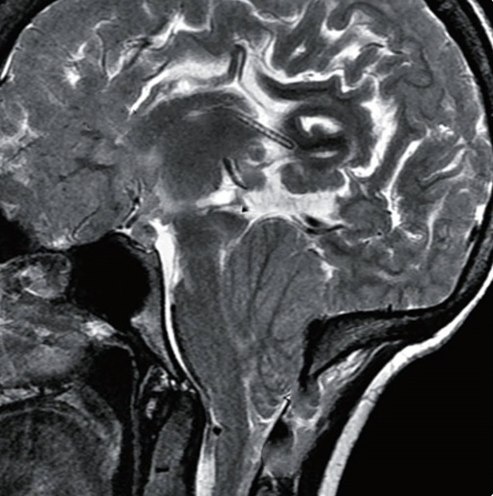 Chiari 2 malformation